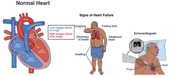 Early Onset Heart Failure | Heart Failure Symptoms – XUUUST
